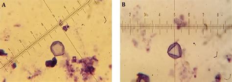 Acanthamoeba Cysts In Primary Morphology Assessment By Giemsa Staining