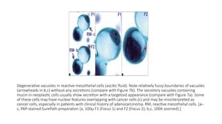 Problems In Reporting Pleural And Peritoneal Fluid Pptx
