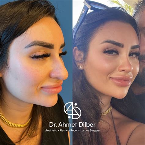 Rhinoplasty Result Dr Ahmet Dilber Nose Surgery Rhinoplasty Nose