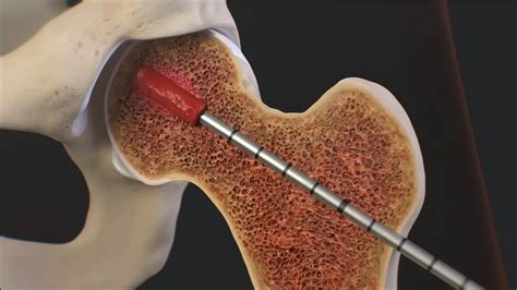 What Is Bone Marrow Routines