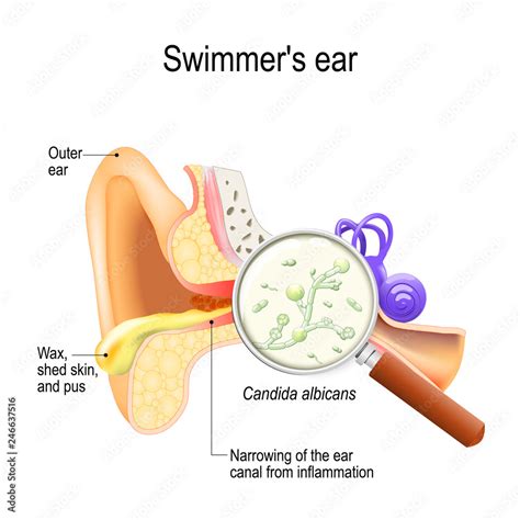 Otitis Swimmers Ear Is Inflammation Of The Ear Canal And Fungal