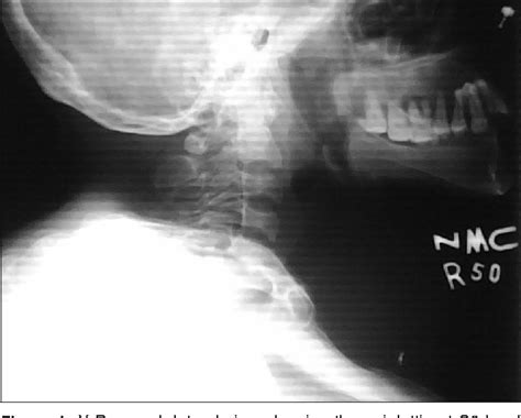 Figure 1 From Mallampati Class ‘zero Yet Another Cause Semantic