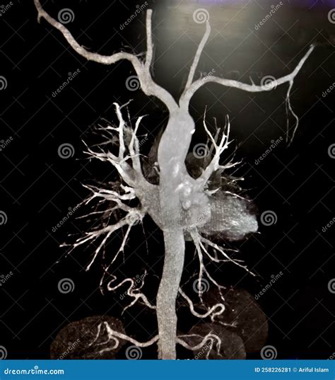 Ct Angiography Computed Tomography Angiography Cta Of Abdominal Aorta Stock Image