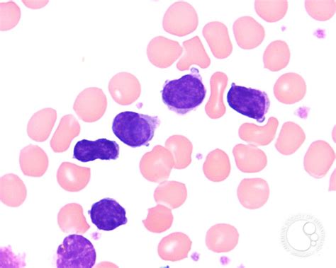Sézary Cells 2