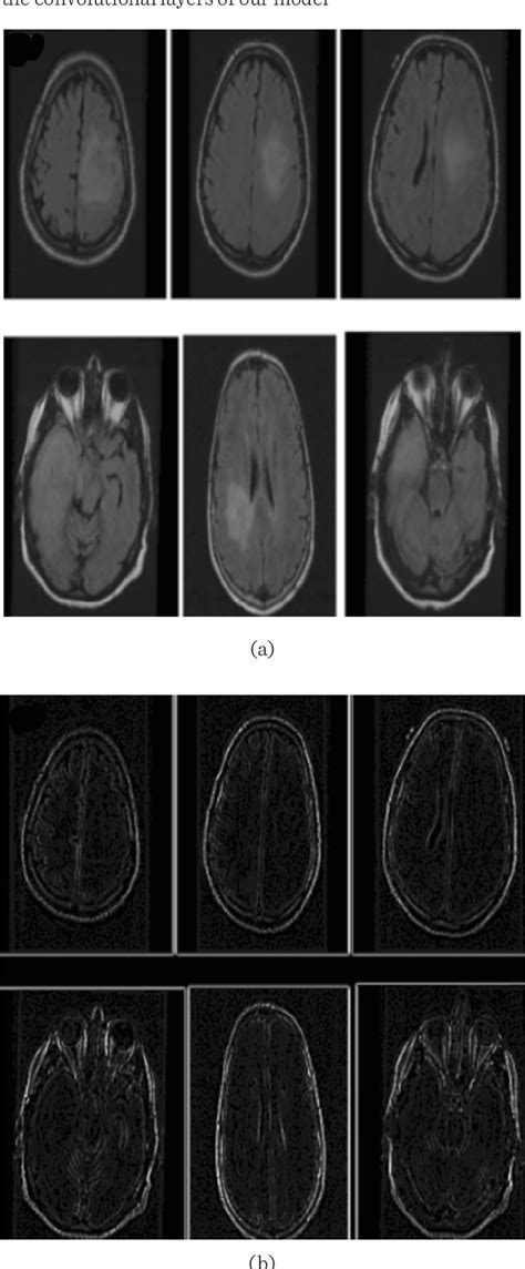 Figure 1 From A Deep Transfer Learning Based Architecture For Brain Tumor Classification Using
