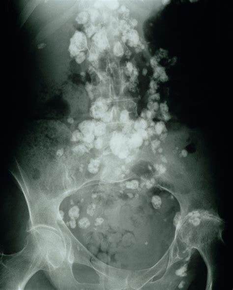 Lymph Node Tuberculosis Photograph By Science Photo Library Fine Art America