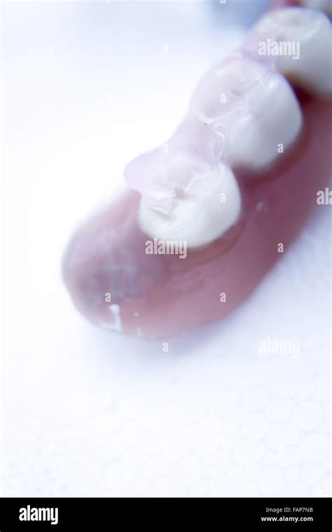 Removable Partial Denture Metal And Plastic Dental False Teeth