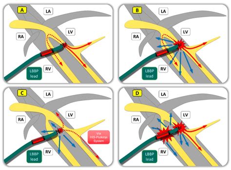 Left Bundle Branch Area Pacing Lbbap Figure 2 Shows Possible