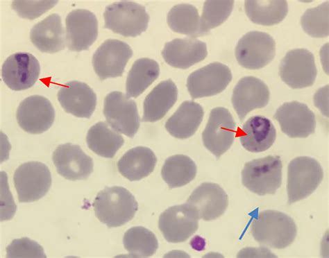 Plasmodium Knowlesi Infection In East Kalimantan F1000research