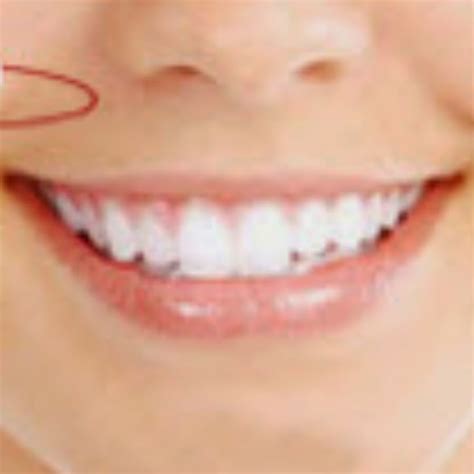 Angular Cheilitis Treatment Youtube