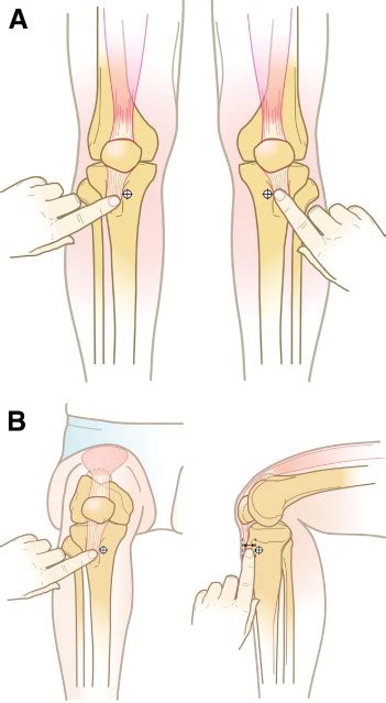 Intraosseous Access In Oral And Maxillofacial Surgical Practice