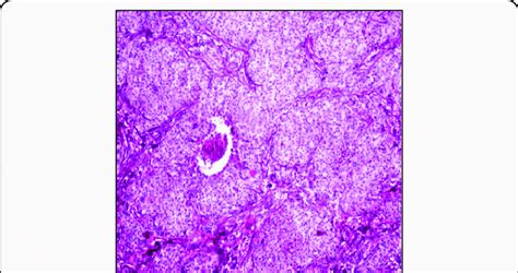 A Characteristic Nesting Pattern Of Tumour Cells Arrow Shows Come Do