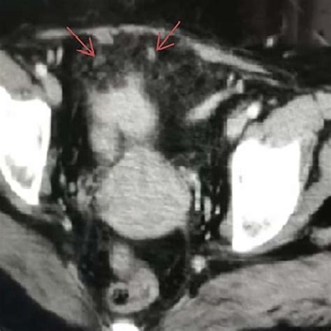Localization Of Subhepatic Abscess In Case 1 Download Scientific Diagram