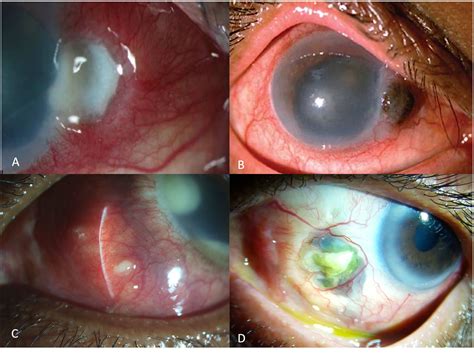 Frontiers Infectious Scleritis A Review Of Etiologies Clinical
