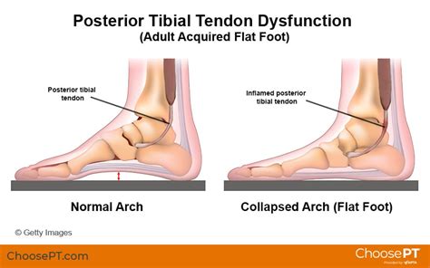 Posterior Tibial Tendonitis Symptoms Causes Treatments 57 Off