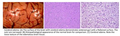 Lecture 9 Cerebral Edema Increased Intracranial Pressure And