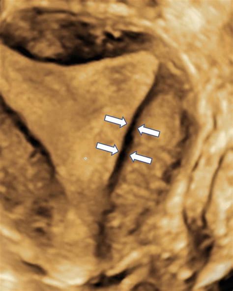 Ultrasound Female Pelvic Anatomy Obgyn Key