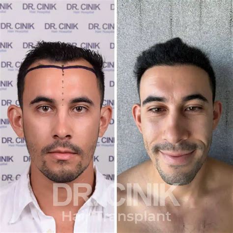 Evolución Del Injerto Capilar Mes A Mes Dr Cinik