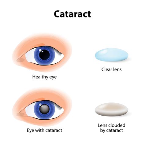 Double Vision And Cataracts Discovery Eye Foundation