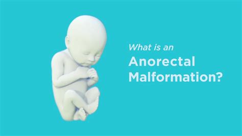 Anorectal Malformation Is The Generic Name That Includes Recto Perineal… Andrea Bischoff