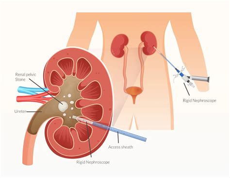 Nephrolithotomy Means
