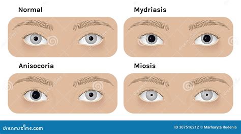 Miosis Vs Mydriasis