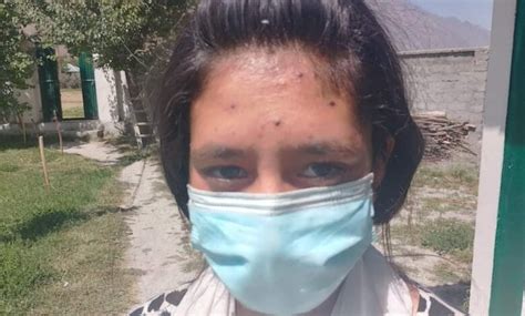 Chickenpox Outbreak Hits Khyber Pakhtunkhwa Schools Closed R Pakistan