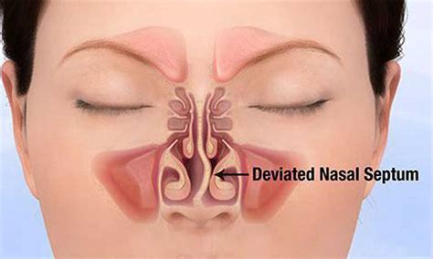 How To Fix A Deviated Septum Naturally Henriette Ragan