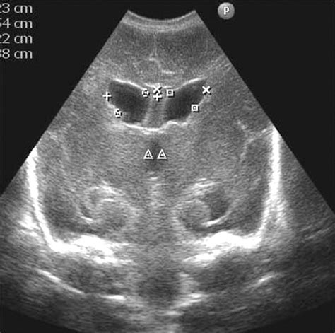 Third Ventricle Ultrasound