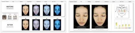 Mark Vu® Skin Analysis System Polaris Medical Aesthetics Laser Facial Clinic Los Angeles