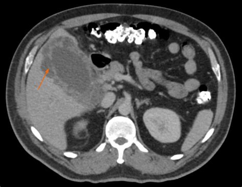 Hodgkin Lymphoma Masquerading As Perforated Gallbladder Adenocarcinoma