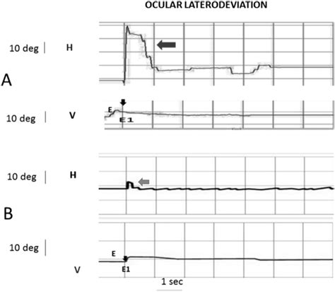 Graphical Recordings Of Ocular Lateral Deviation Old In A Patient Download Scientific Diagram
