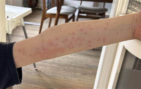 Is This Cold Urticaria Rcoldurticaria
