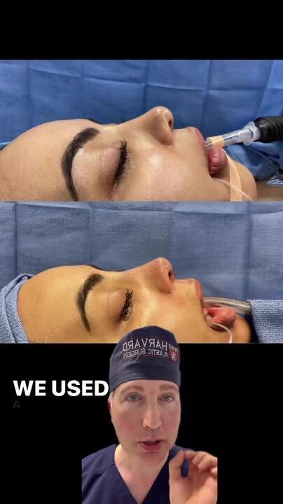 Finesse Rhinoplasty For Tip Refinement Video Realself