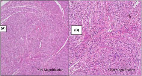 Unusual Case Of Broad Ligament Leiomyoma A Diagnostic And Surgical