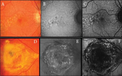 Imaging In Age Related Macular Degeneration Amd A C Color Fundus Download Scientific