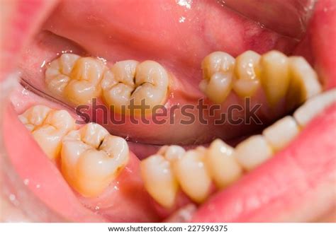 What Healthy Teeth Look Like