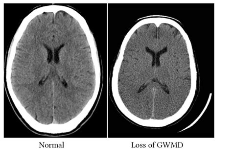 Radiological Findings In Hypoxic Ischaemic Encephalopathy Deranged