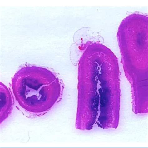 Standard Protocol Appendectomy Slide A Cross Section Of Proximal
