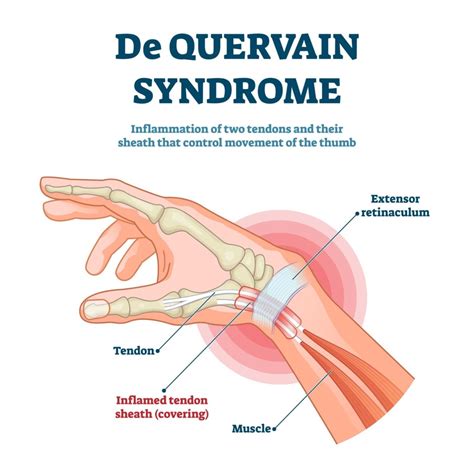 De Quervains Tenosynovitis Complete Physio