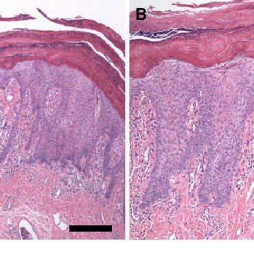 Histopathology Of Skin Lesions Parakeratotic Hyperkeratosis