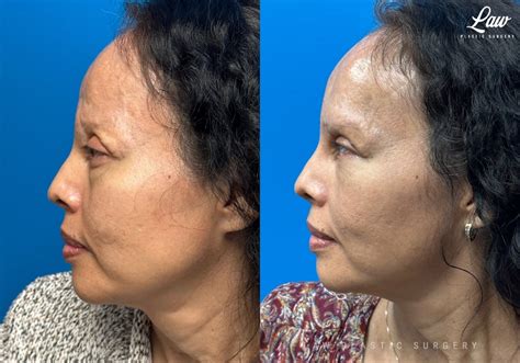 Craniofacial Reconstruction Before And After Photos Law Plastic Surgery