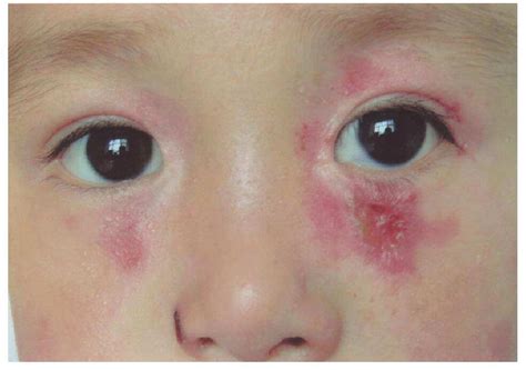 12交界性大疱性表皮松解症 儿童皮肤病图谱