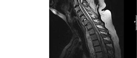 Mri Of The Spine Large Intraspinal Tumor Which Extended To The