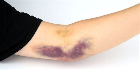 Plateletpheresis Wikipedia