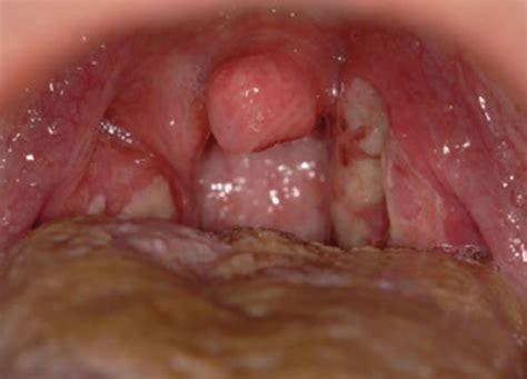 Syphilitic Tonsillitis In Primary Care A Case Report British Journal