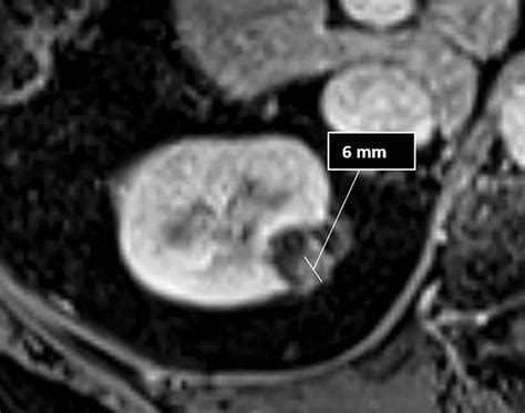 Bosniak Classification Of Cystic Renal Masses Version 2019 A