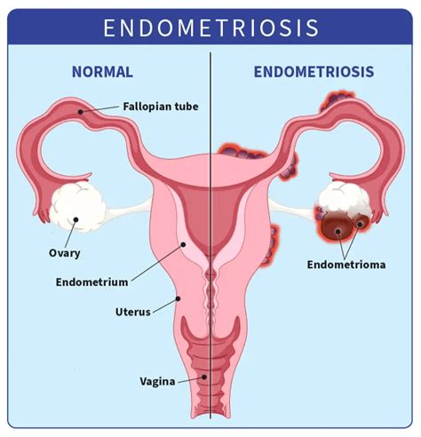 Endometriosis Symptoms Treatment And Importance Newshunts24 News
