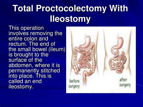 Ppt Colon Cancer Powerpoint Presentation Id3297970