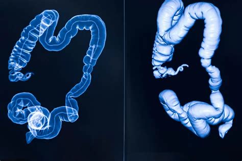 Treating Diverticulitis Options And Recovery Explained